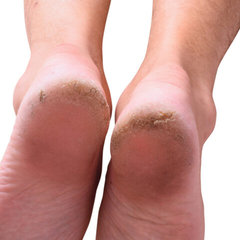 Corns and Callus - Belinda Billinge | Business Mentor to Foot Health ...